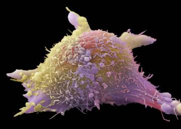 Una inmunoterapia de precisión para el cáncer de mama | Ciencia | EL PAÍS