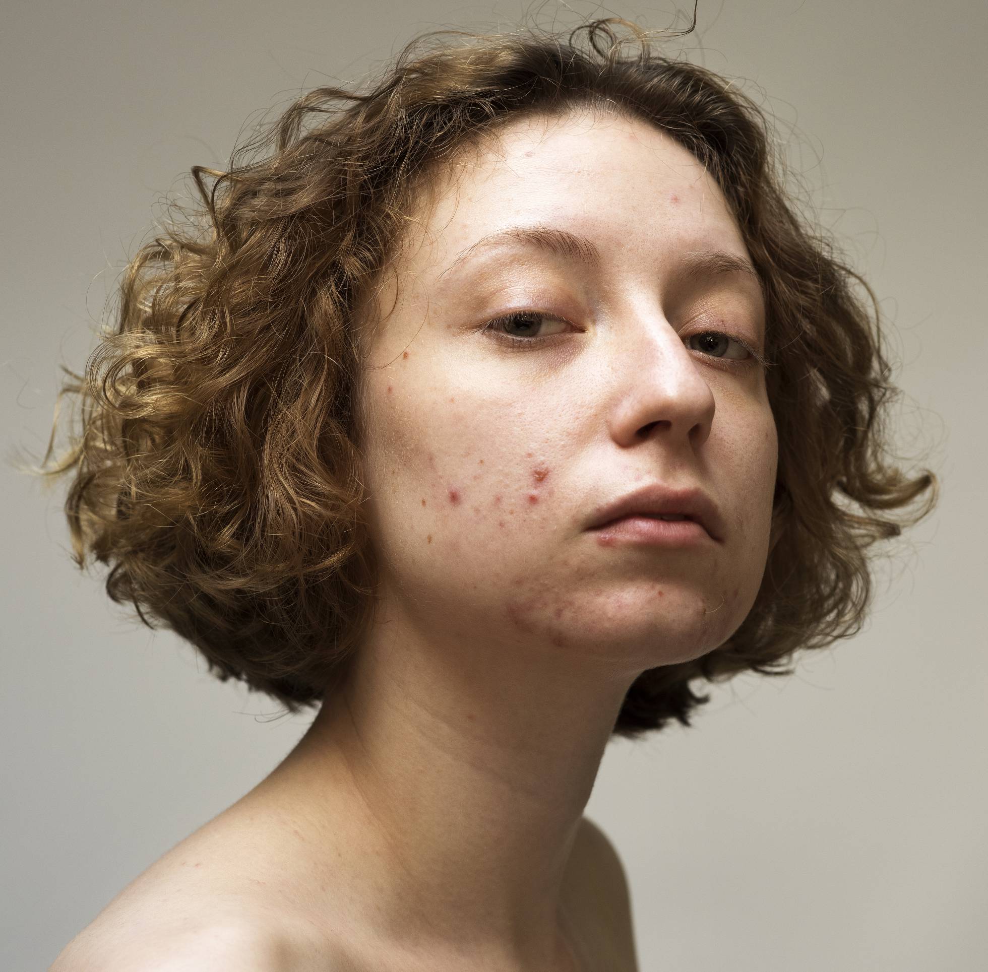 Mujeres que reclaman la visibilización del acné: "Me ha afectado tanto ...