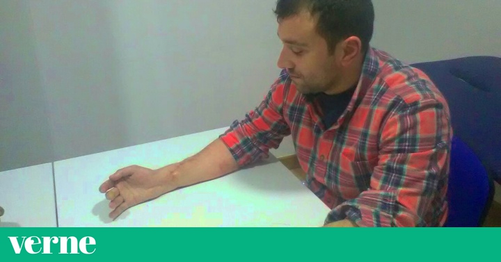 Perdí la mano en un accidente laboral y horas después la tenía otra vez ...